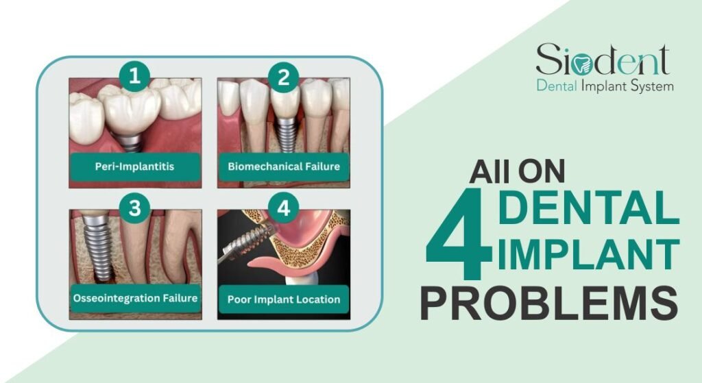 What Are the Problems with All-on-4 Dental Implants? - siodent