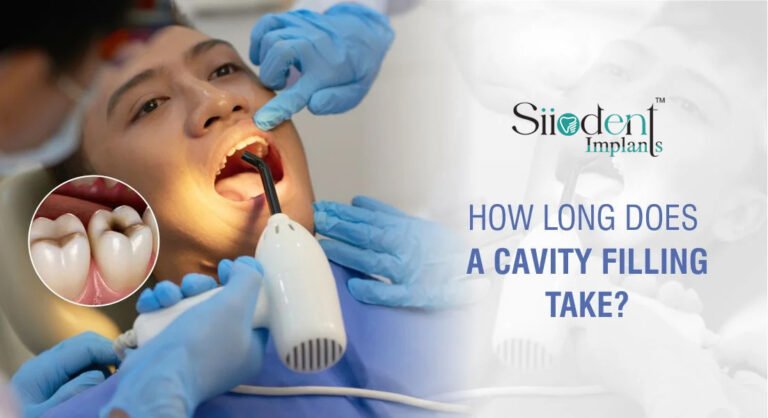 How Long Does a Cavity Filling Take? - siiodent